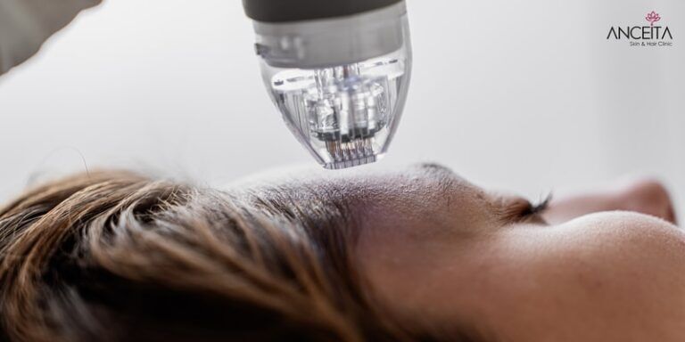 MNRF Treatment: Cost, Benefits, Results & Side Effects